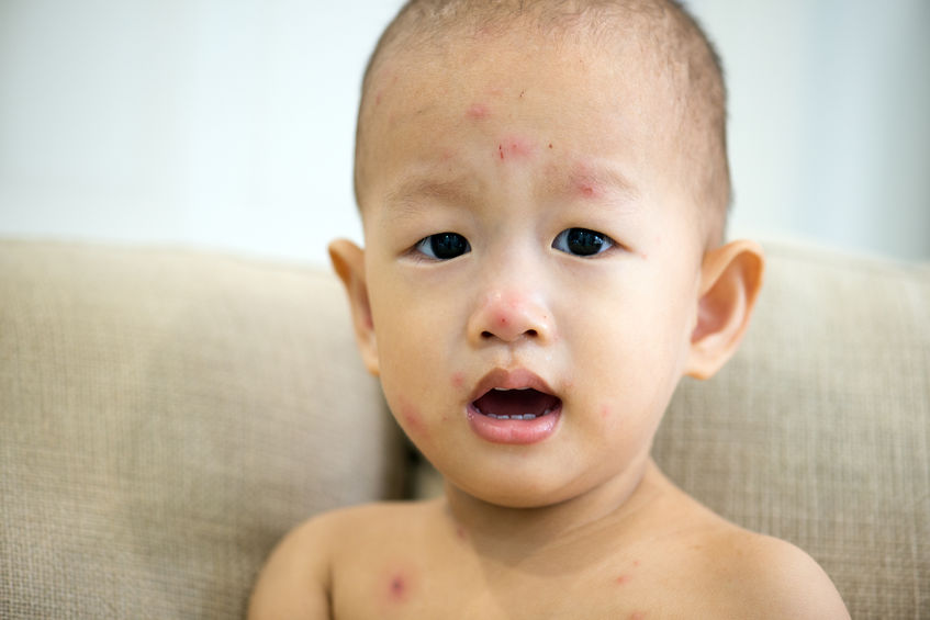 The Infectious Chicken Pox