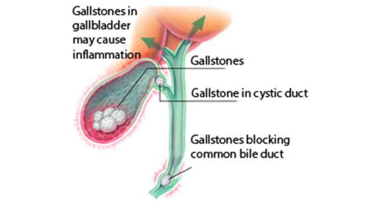The Choking Gall: The Curse…